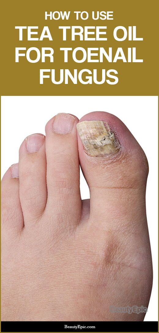 Tea Tree Oil To Treat Toenail Fungus And How To Use It In 2025