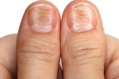 Ridges In Fingernails - Types, Causes And Treatment In 2025