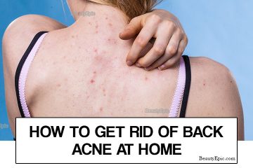 How To Get Rid Of Back Acne Fast Naturally