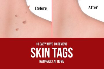 How To Remove Skin Tags Naturally At Home?