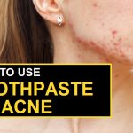 How to Use Manuka Honey for Acne?