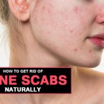 How to Get Rid of Acne on Cheeks and Chin Naturally