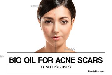 How To Use Bio Oil For Acne Scars?