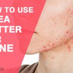 How Effective is Aloe Vera for Acne?