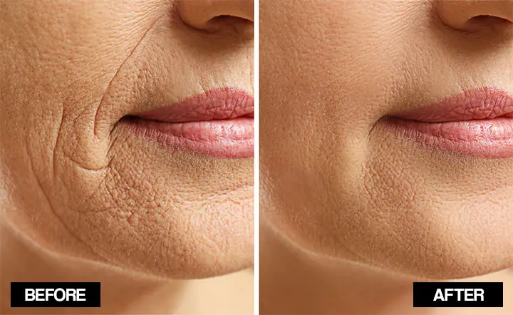 20 Effective Home Remedies To Get Rid of Wrinkles Naturally