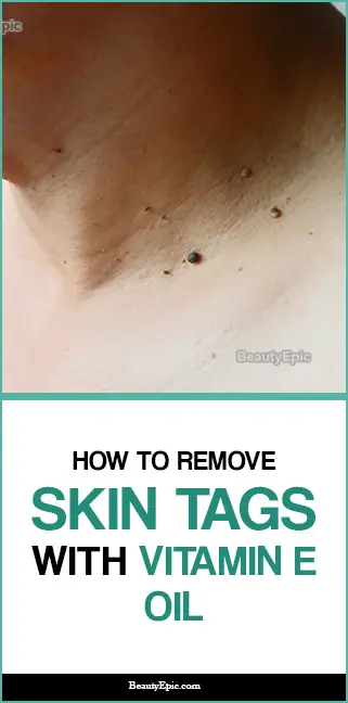Vitamin E oil for Skin Tag Removal - Does it Work?