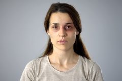 How To Cover A Bruise With Makeup?