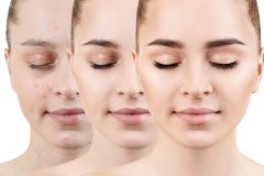 How To Determine Your Skin Tone?