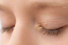 Skin Tags On Eyelids: Causes And Removal Treatment In 2026