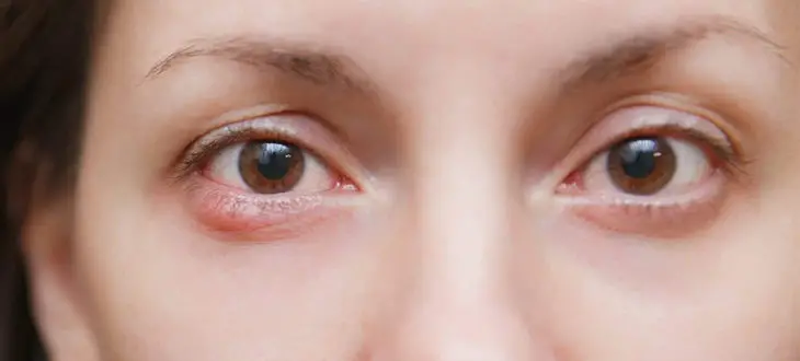 Essential Oils For Eye Stye
