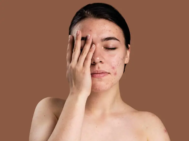 10 Best Ways To Hide Dark Spots On Your Face Without Makeup In 2023 10-best-ways-to-hide-dark-spots-on-your-face-without-makeup-in-2023